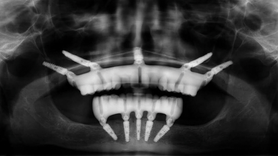 Partially Guided Remote Anchorage With a Full-Arch Digital Workflow ...