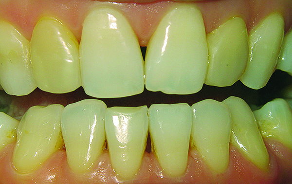 Utilizing Pressable Ceramics for a Cosmetic Anterior Case: Part I ...