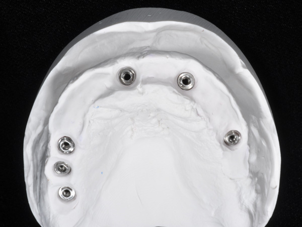 Predictable Casting for Full Arch Splinted Implant Frameworks | Inside ...