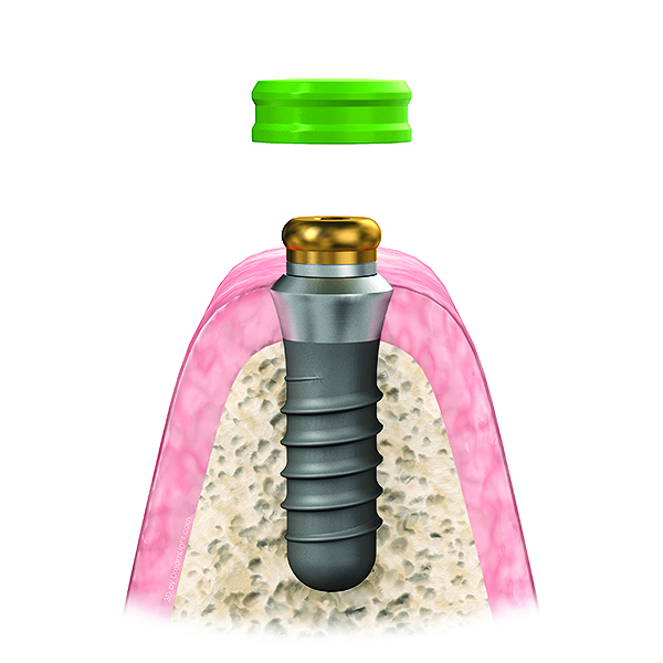 Stern SNAP Angled Offers True Angle Correction for Overdentures ...