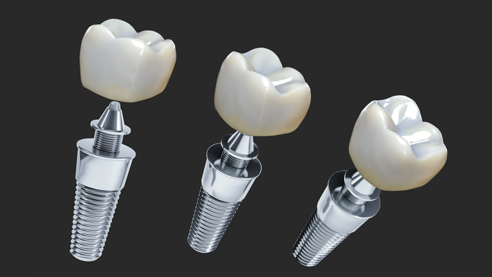 Ti-Bases and the Lab's Role | Inside Dental Technology